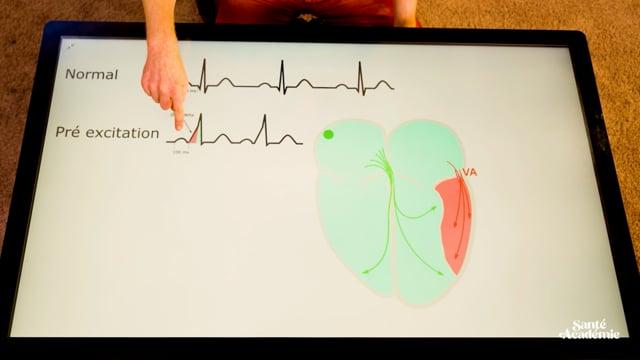 Formation ECG - Lecture et interprétation | Santé Académie