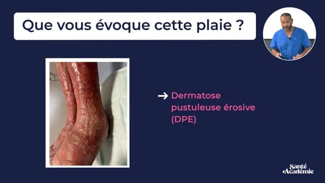 Formation Plaies, Cicatrisation, Pansements IDE en ligne | Santé Académie